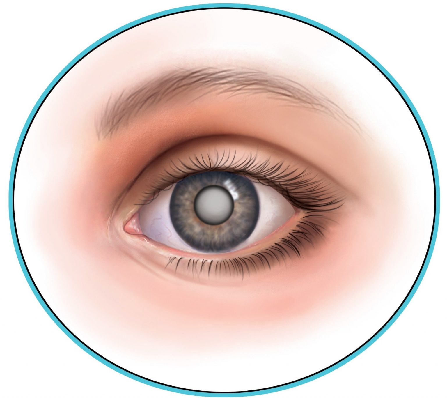 Como é a catarata: 4 exemplos de manifestação da doença ocular