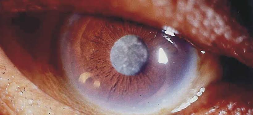 Como é a catarata: 4 exemplos de manifestação da doença ocular