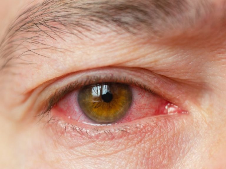 Pressão Intraocular: Sintomas, Causas, Riscos e Tratamento