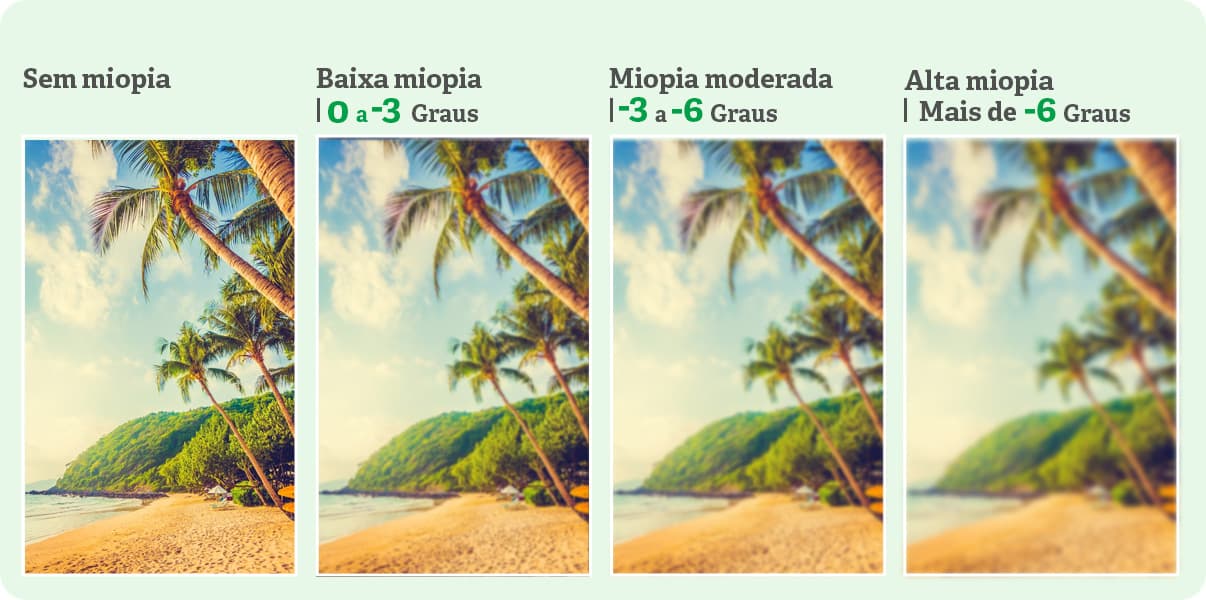 Miopia: O Que É, Sintomas, Causas e Principais Tratamentos